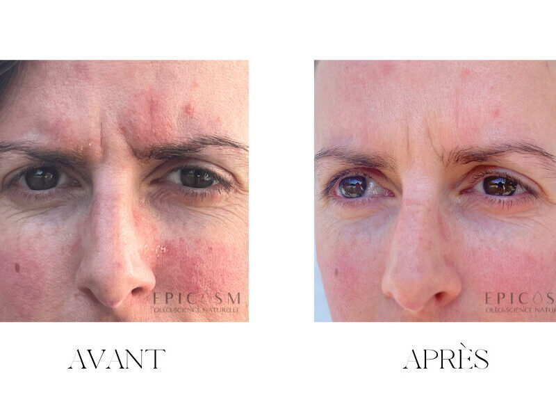 La dermite ou dermatite séborrhéique. Qu'est ce que c'est ? Comment la ...